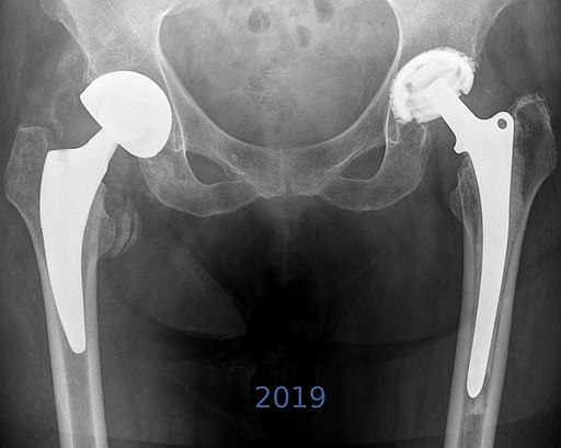 Heterotopic Ossification